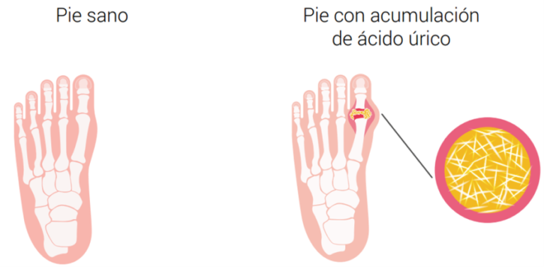 Gota: Causas, Síntomas y Tratamientos Efectivos - Laboratorio Bioclinic